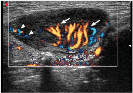 Đặc Điểm Siêu Âm Hạch Ác Tính Vùng Cổ (Ultrasound of malignant cervical ...