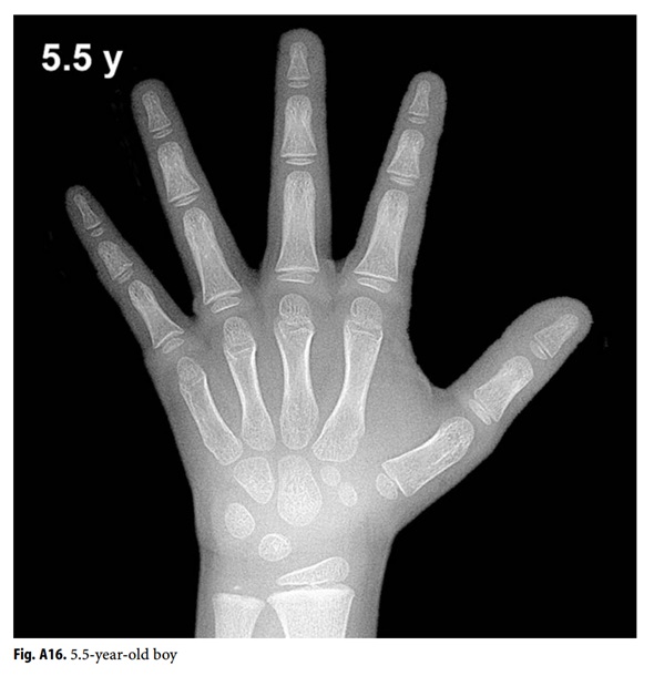 Anhvanyds - Hand Bone Age (Tuổi xương bàn tay)