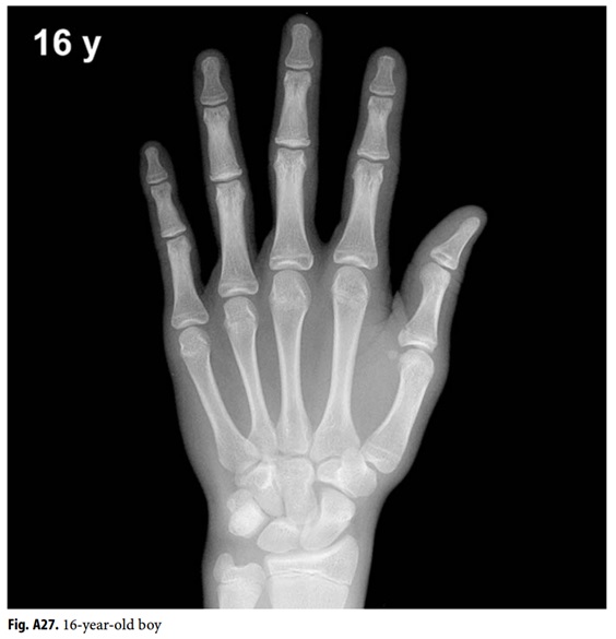 Anhvanyds - Hand Bone Age (Tuổi xương bàn tay)