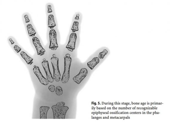 Anhvanyds - Hand Bone Age (Tuổi xương bàn tay)