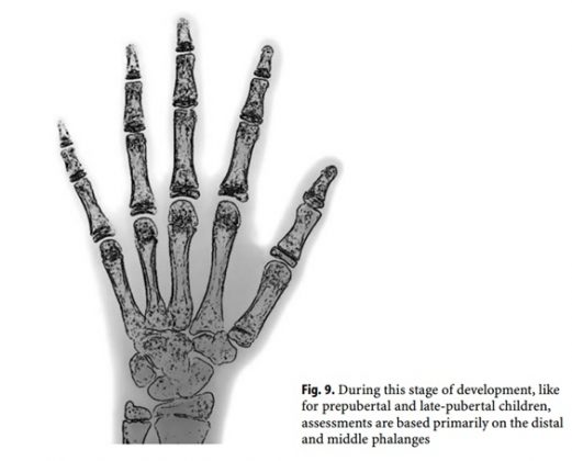 Anhvanyds - Hand Bone Age (Tuổi xương bàn tay)
