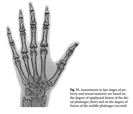 Anhvanyds - Hand Bone Age (Tuổi xương bàn tay)