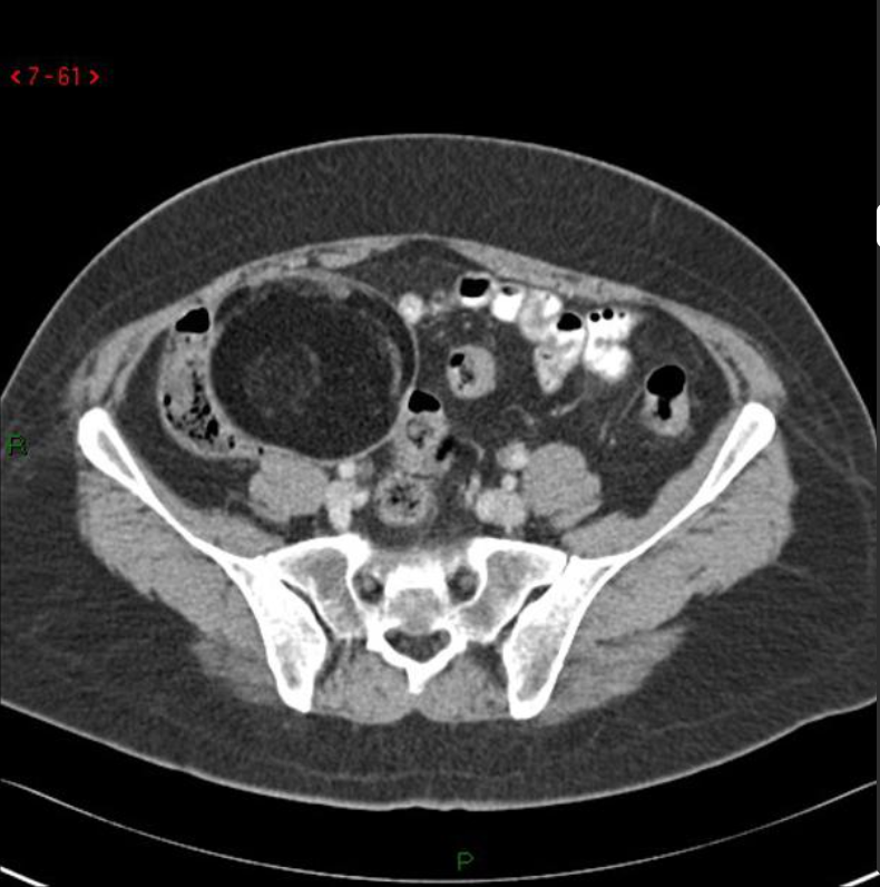 Nang bì buồng trứng (Ovarian dermoid cyst)