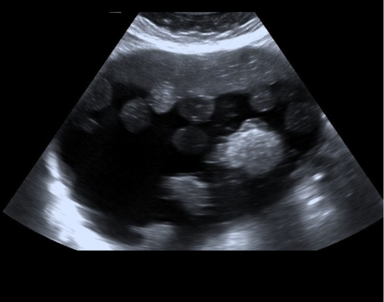 Nang bì buồng trứng (Ovarian dermoid cyst)