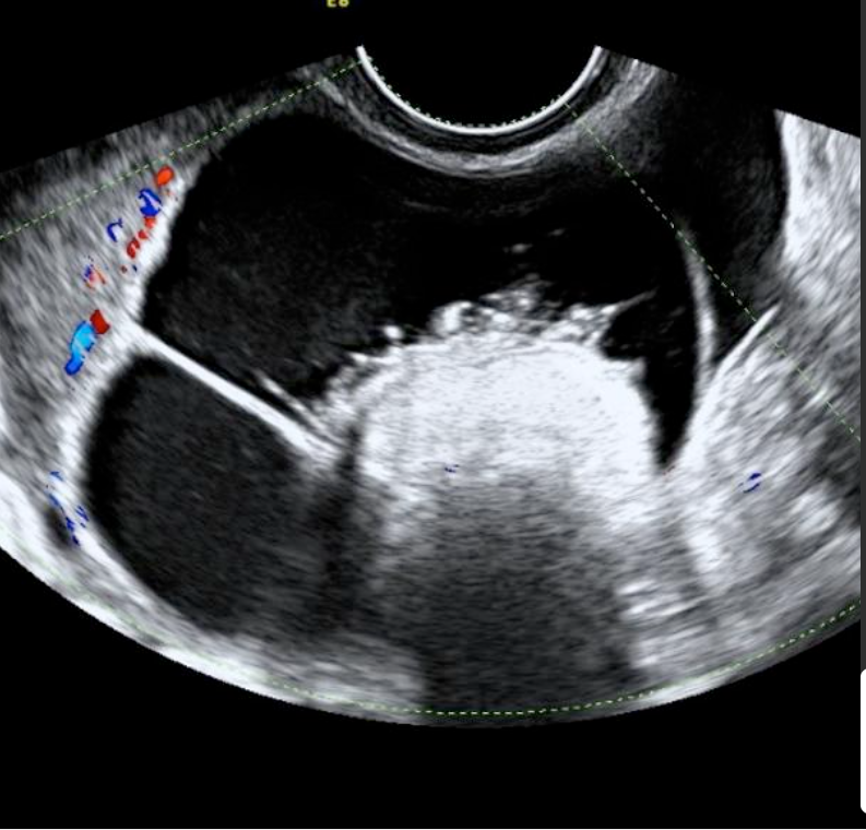 Nang bì buồng trứng (Ovarian dermoid cyst)
