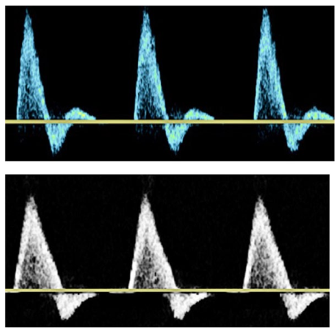 Anhvanyds - Diễn giải các dạng sóng Doppler động mạch và tĩnh mạch ...