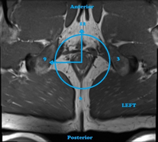 Anhvanyds - Rò quanh hậu môn (Perianal fistula)