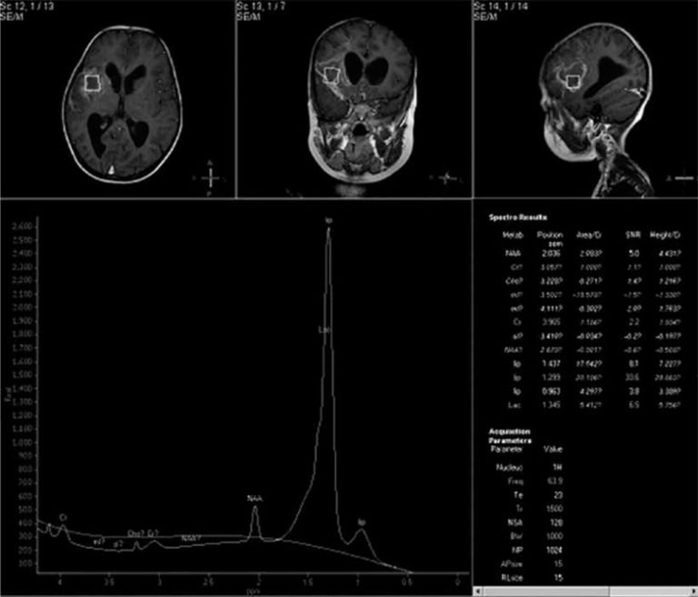 Anhvanyds - Hình ảnh cộng hưởng từ (MRI) các tổn thương lao nội sọ: một ...