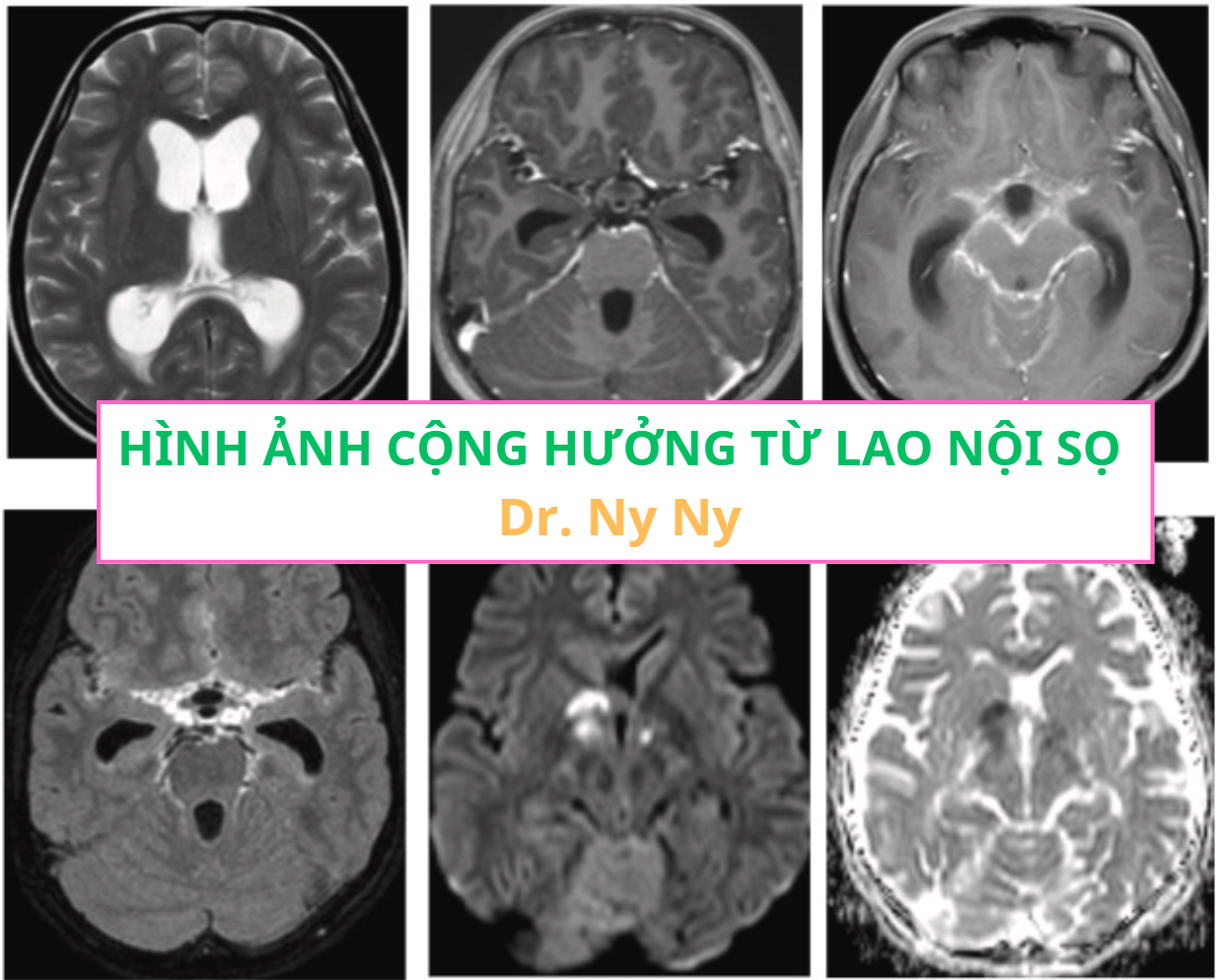 Anhvanyds - Hình ảnh cộng hưởng từ (MRI) các tổn thương lao nội sọ: một ...