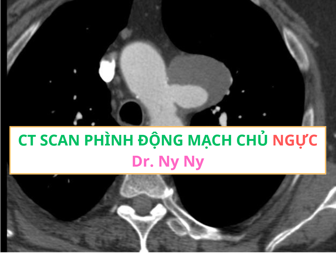 Anhvanyds - Hình ảnh cắt lớp vi tính đa dãy đầu dò của phình động mạch ...